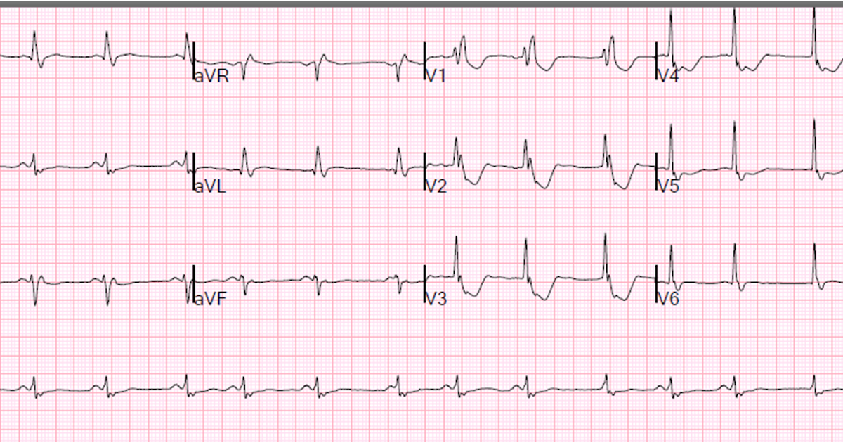 Dr. Smith's ECG Blog: Male in his 50's resuscitated from ventricular ...