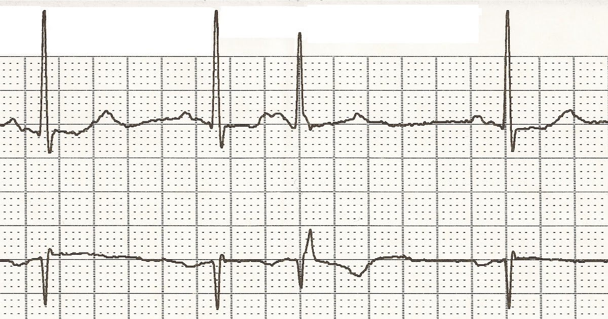 EKG Rhythm Strips 09