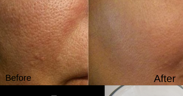 Angie's Lifestyle Tips: Reduce Your Pores quickly with these Natural ...