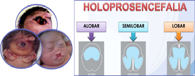 Neurociencias: Ontogénesis del sistema nervioso: ANOMALÍAS DEL ENCÉFALO