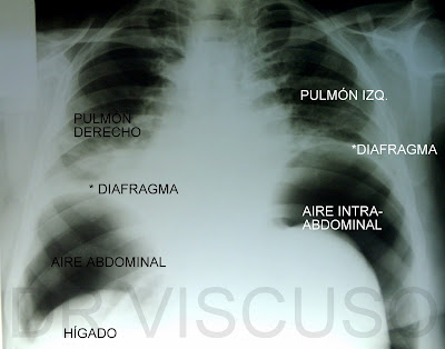 Que vi hoy: Neumoperitoneo gigante
