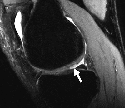 MRI Protocols: Cartilage Imaging Sequences in Knee Joint MRI imaging