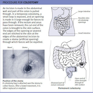 colostomy ~ Nursing