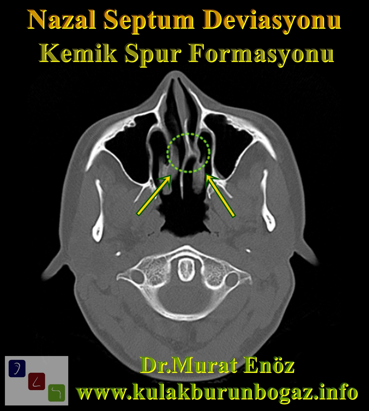 Health Zone Turkey: Nasal Bone Spur - Symptoms, Diagnosis, Treatment