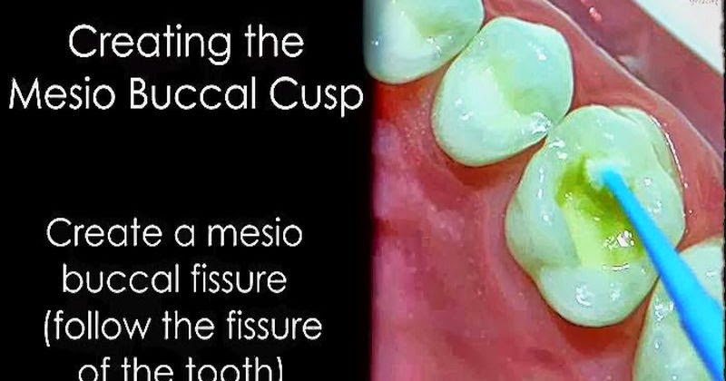 OPERATIVE DENTISTRY: Class I Composite Restoration - Dr. Jason Smithson ...