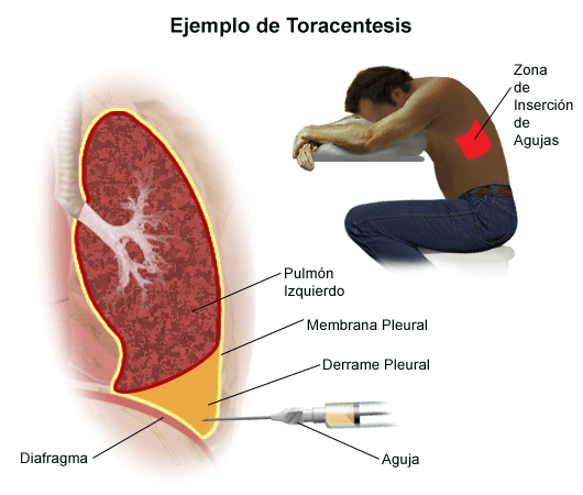 Pruebas Dx: ¿Cómo se realiza una toracocentesis?