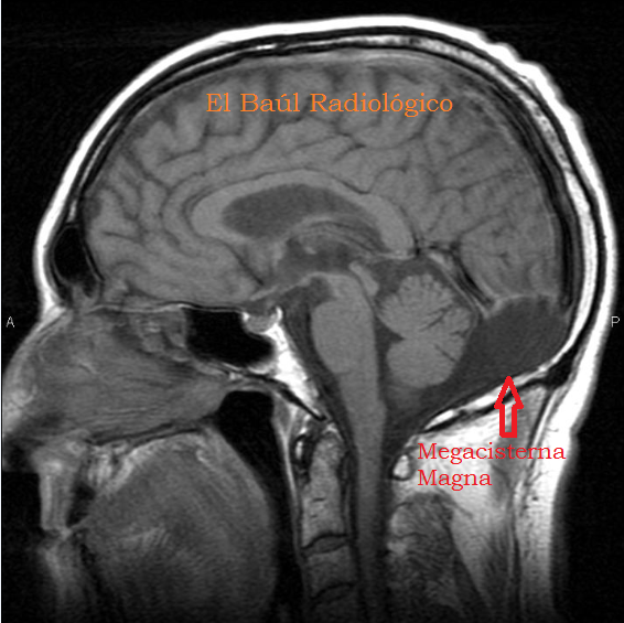 El Baúl Radiológico: ASPECTO DE LA CISTERNA MAGNA EN TOMOGRAFÍA ...