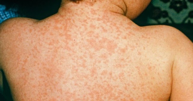 2NURFM Hunter News: Diagnoses of Baby in Newcastle With Meningococcal ...