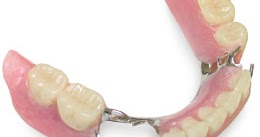 Esthetic Cast Direct Retainers for Distal Extension Removable Partial ...