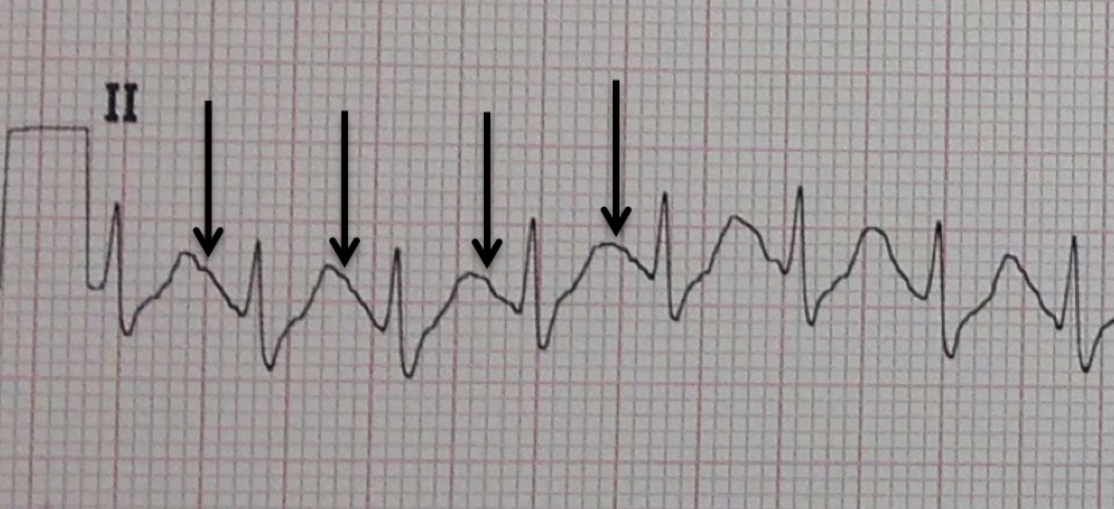 Dr. Smith's ECG Blog: A Relatively Narrow Complex Tachycardia at a Rate ...