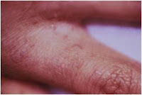 How To Eradicate Scabies On Face ~ How to Kill Scabies