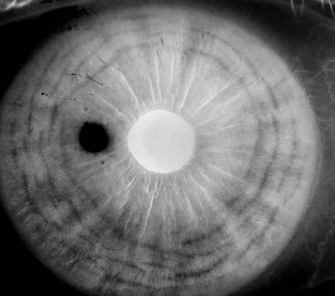Modern & Multidimensional Iridology: Pupil Applanations, Schwalbe's ...