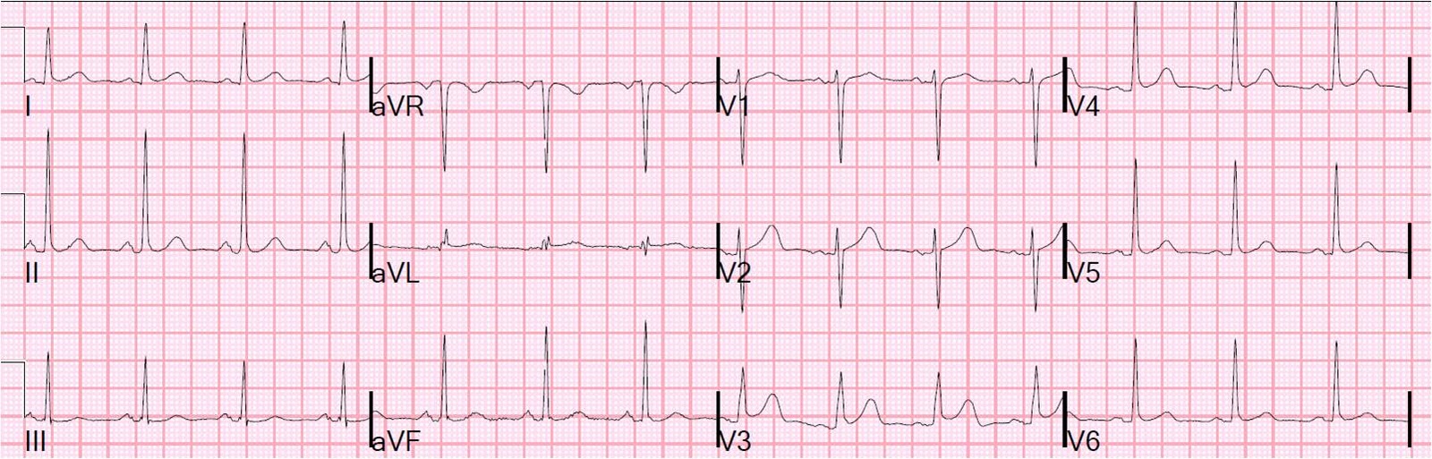 Dr. Smith's ECG Blog: Several Cases of ST Elevation from Early ...