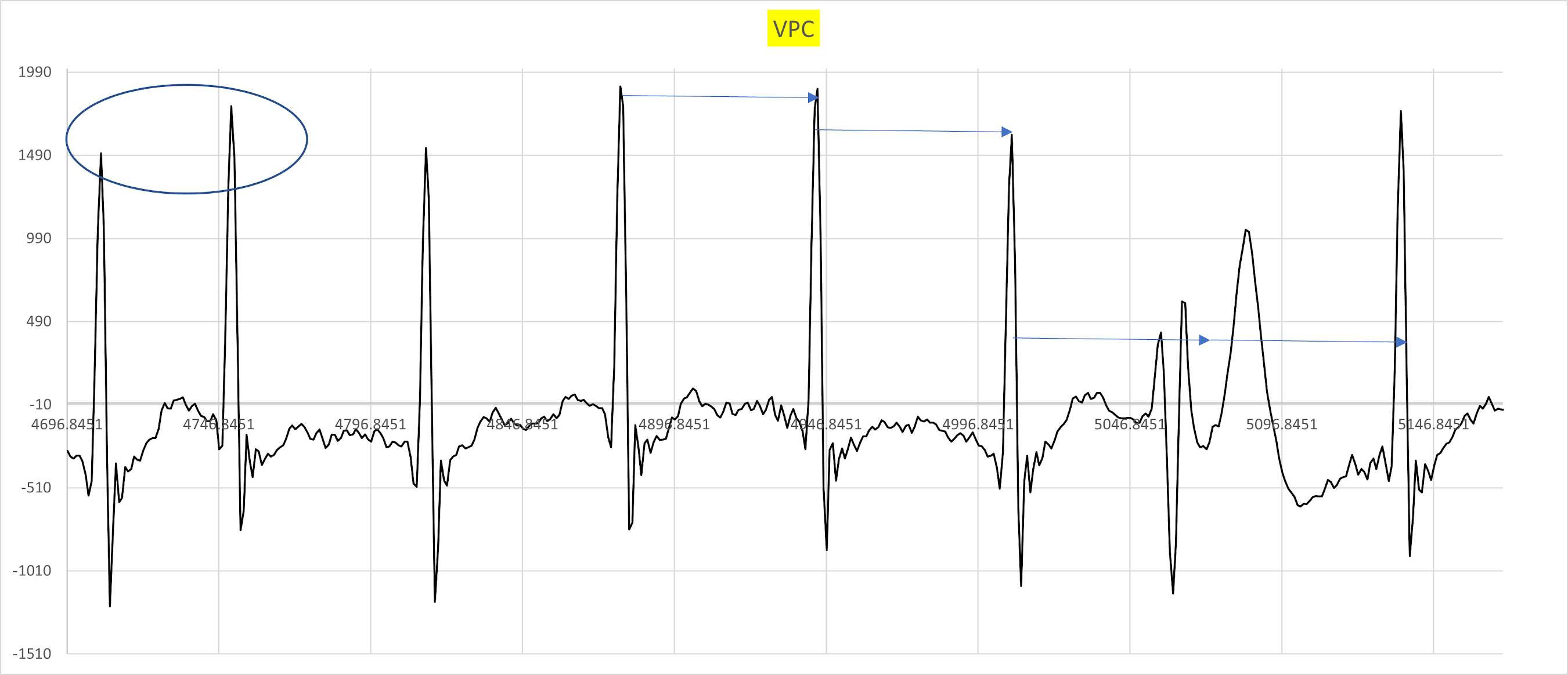 Muscle Oxygen Training: ECG Arrythmia/Artifact visualization - some tips
