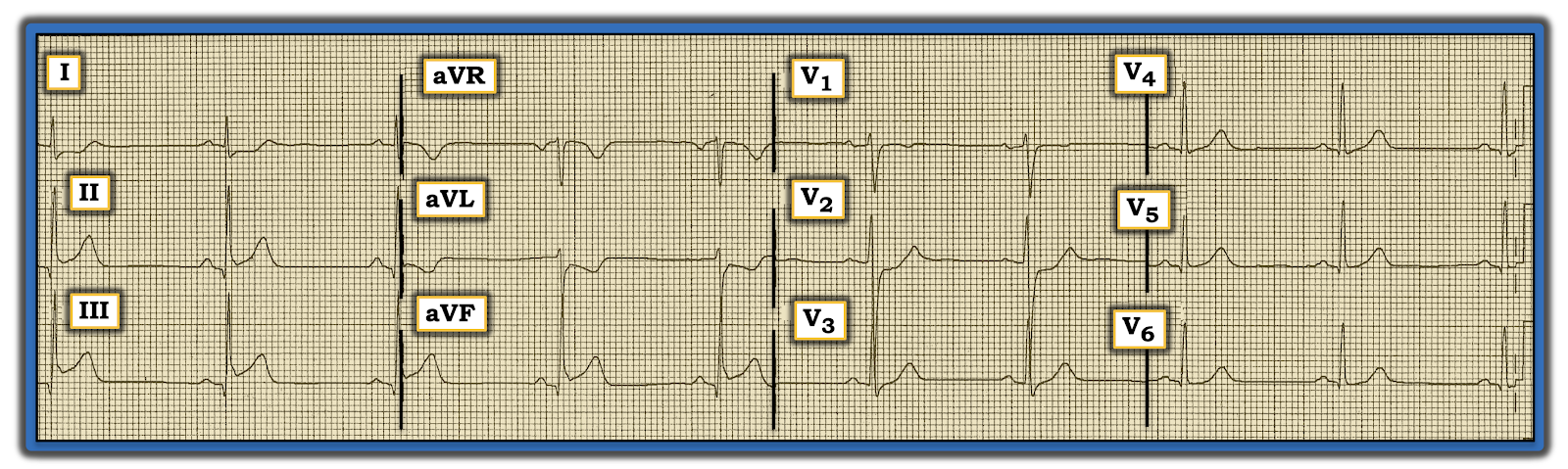 ECG Interpretation: ECG Blog #171 (Culprit Artery - Repolarization ...