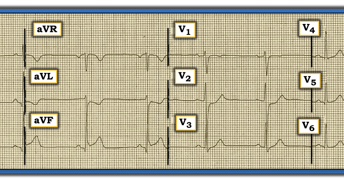 ECG Interpretation: ECG Blog #171 (Culprit Artery - Repolarization ...