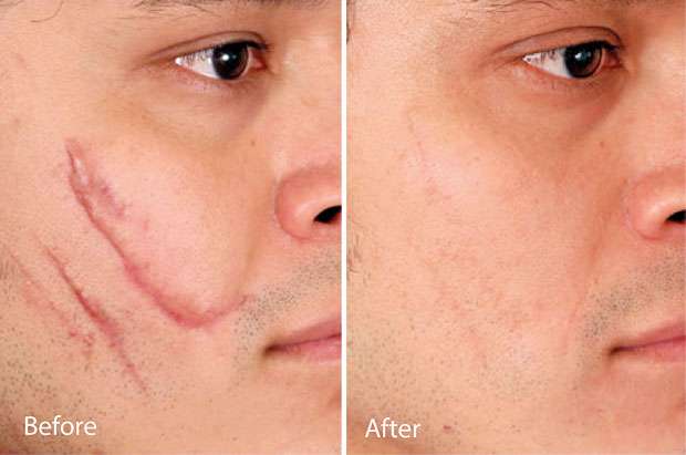 How to Remove Scars - Scar Removal That Works? - Dubai Laser Treatment