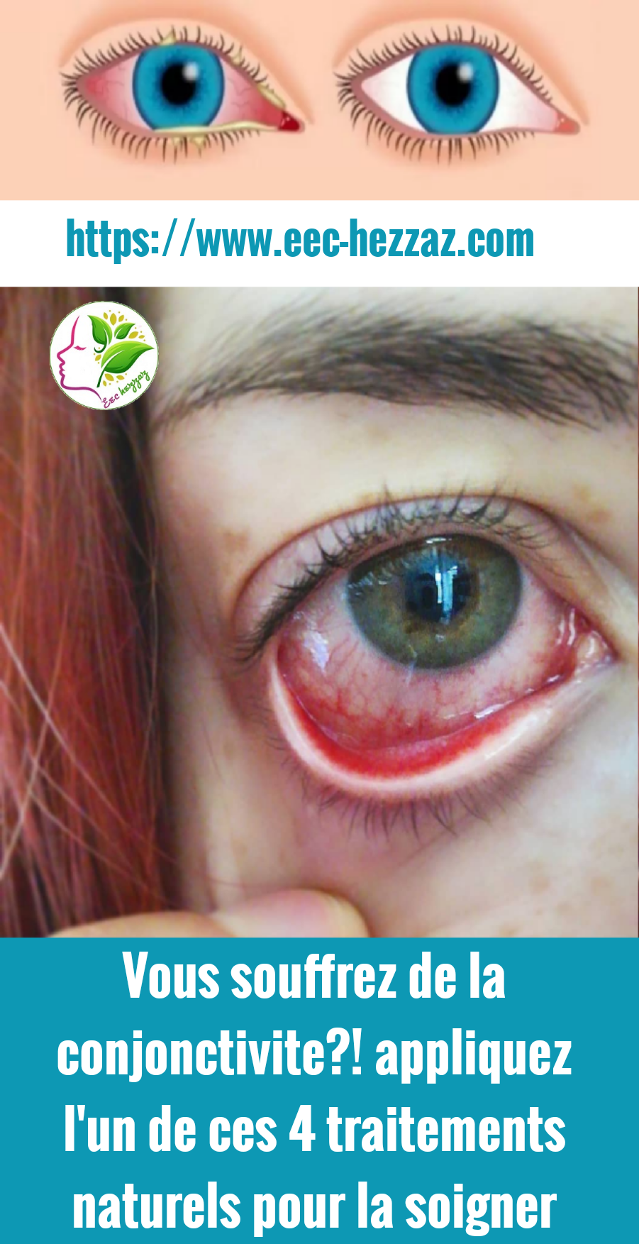 Vous souffrez de la conjonctivite?! appliquez l'un de ces 4 traitements ...