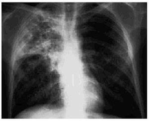 BANCO DE IMAGENES DE SX PREUROPULMONARES