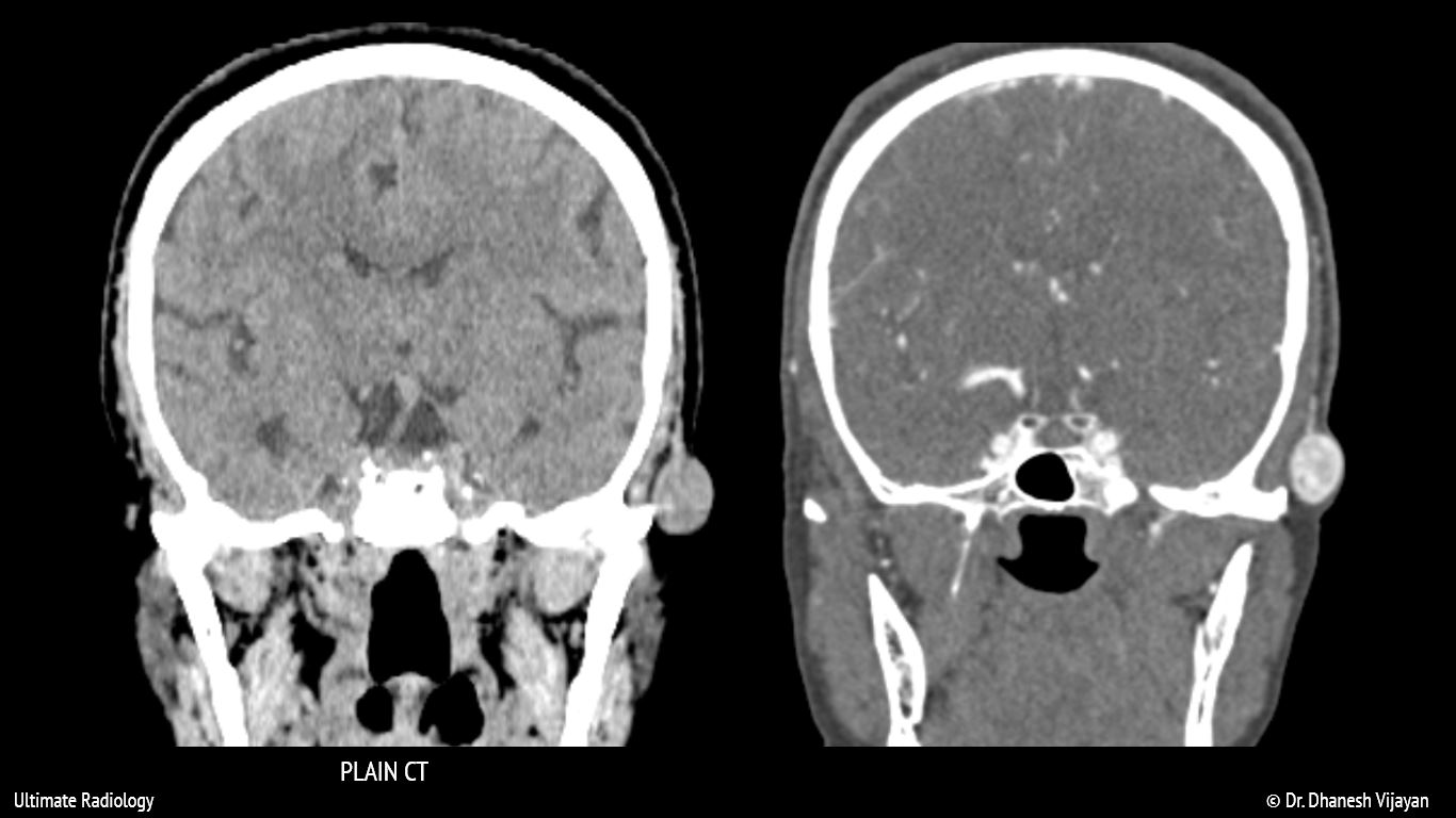 Ultimate Radiology : Superficial Temporal Artery Pseudoaneurysm
