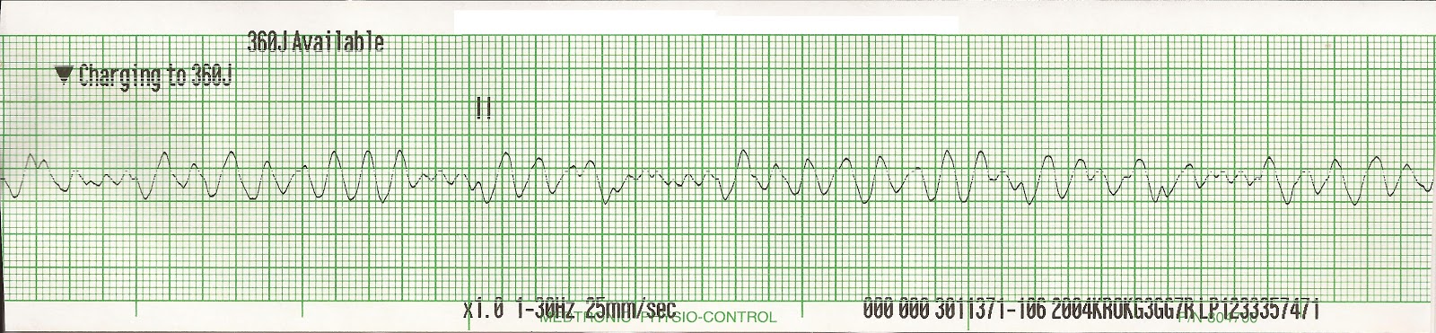 Float Nurse: Pulseless VF/VT