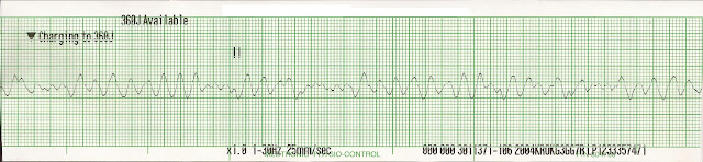 Float Nurse: Pulseless VF/VT