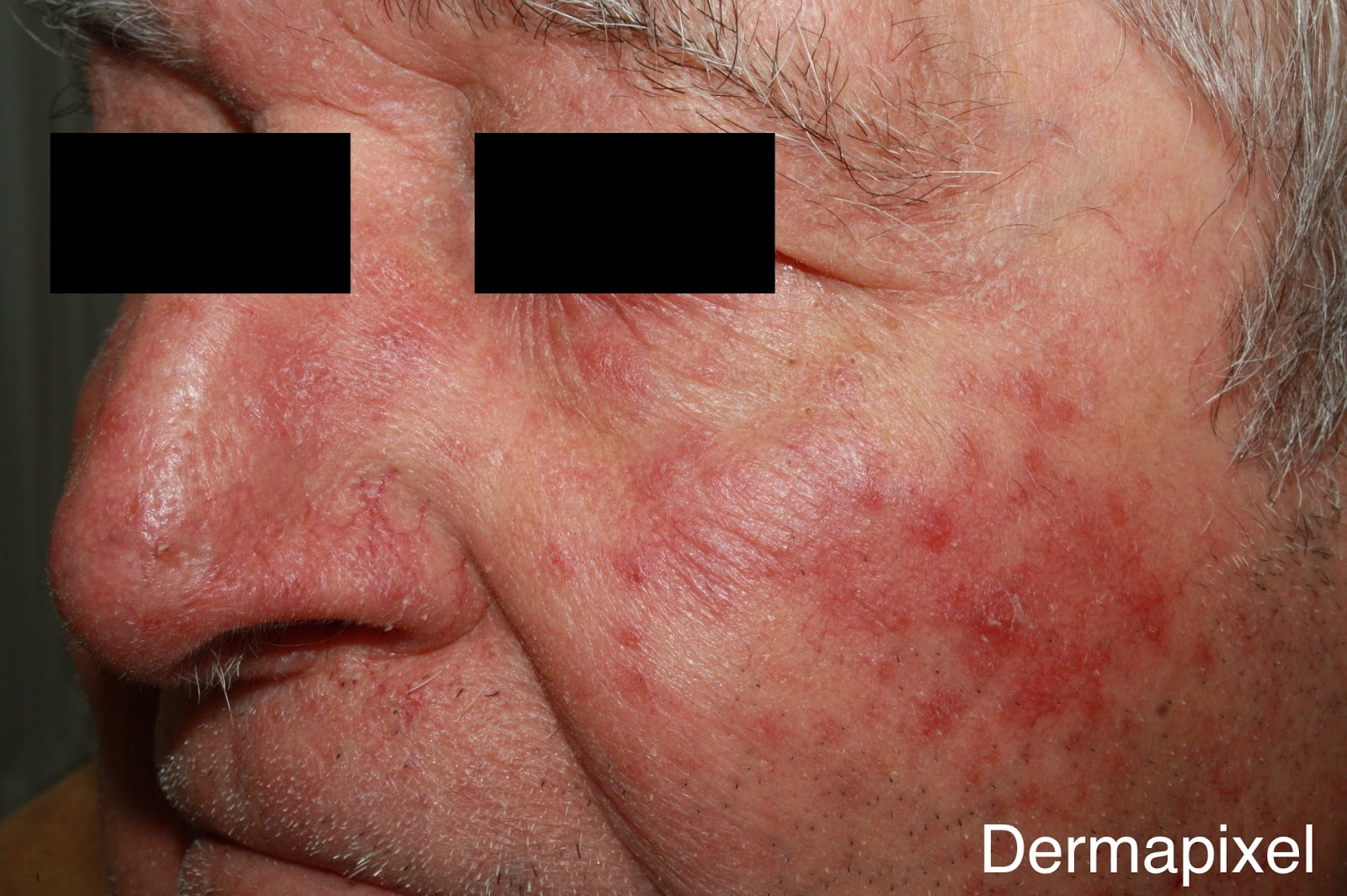 Dermapixel: marzo 2018