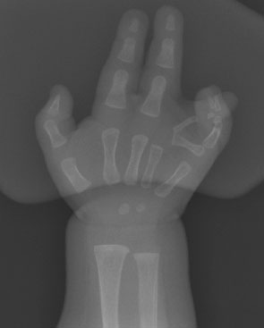 Ulnar cleft hand, part II | Congenital Hand and Arm Differences ...