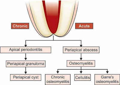 Pulp and periapical pathosis l Endodontics 5th year MCQs for dental ...