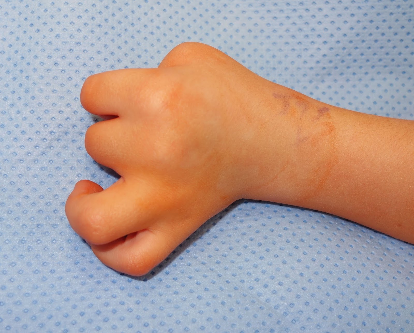 The Hand in Arthrogryposis | Congenital Hand and Arm Differences ...