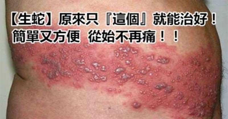 治療【生蛇】的秘方,請分享出去 功德無量!