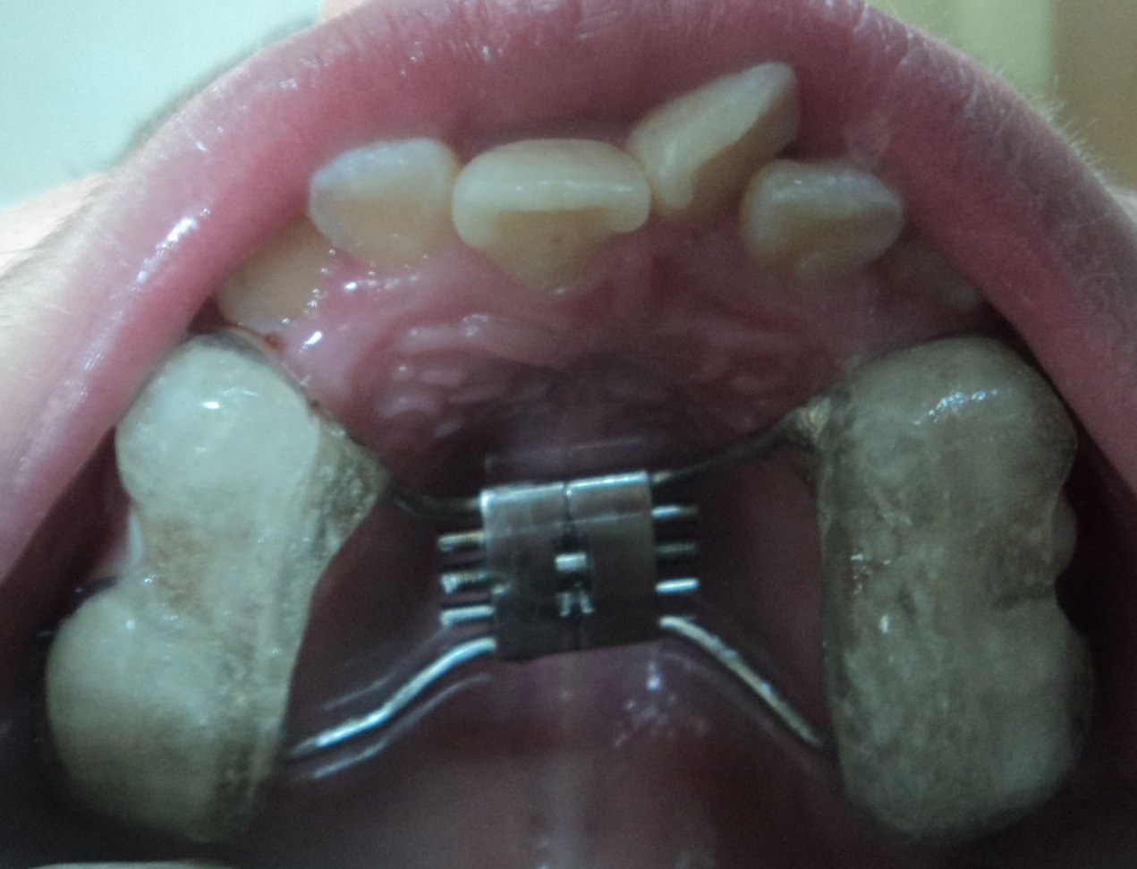 ODONTO-ESTOMATOLOGICA: APARATO DISYUNTOR HIRAX