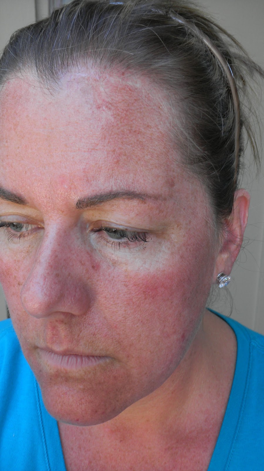 Efudex and Me 2013: Efudex Days Six and Seven