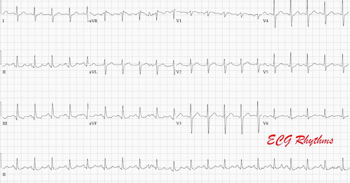 ECG Rhythms: Pulmonary Embolism