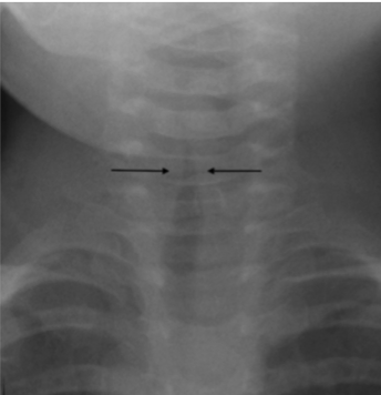EM Didactic: Croup - Laryngotracheobronchitis