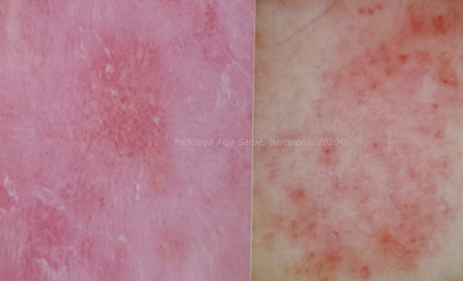 Dermatoscopia en podología