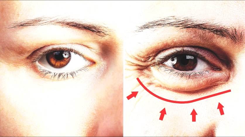 7 Habits That Cause Under Eye Puffiness (And How to Fix It)