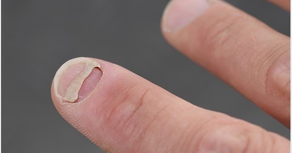 Pediatrics Notes: Nail Separation