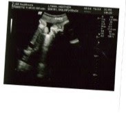 Lyman: Pregnancy Update