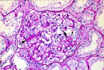 Definition, classification and pathogenesis of FSGS ~ The Healthy Diet Type