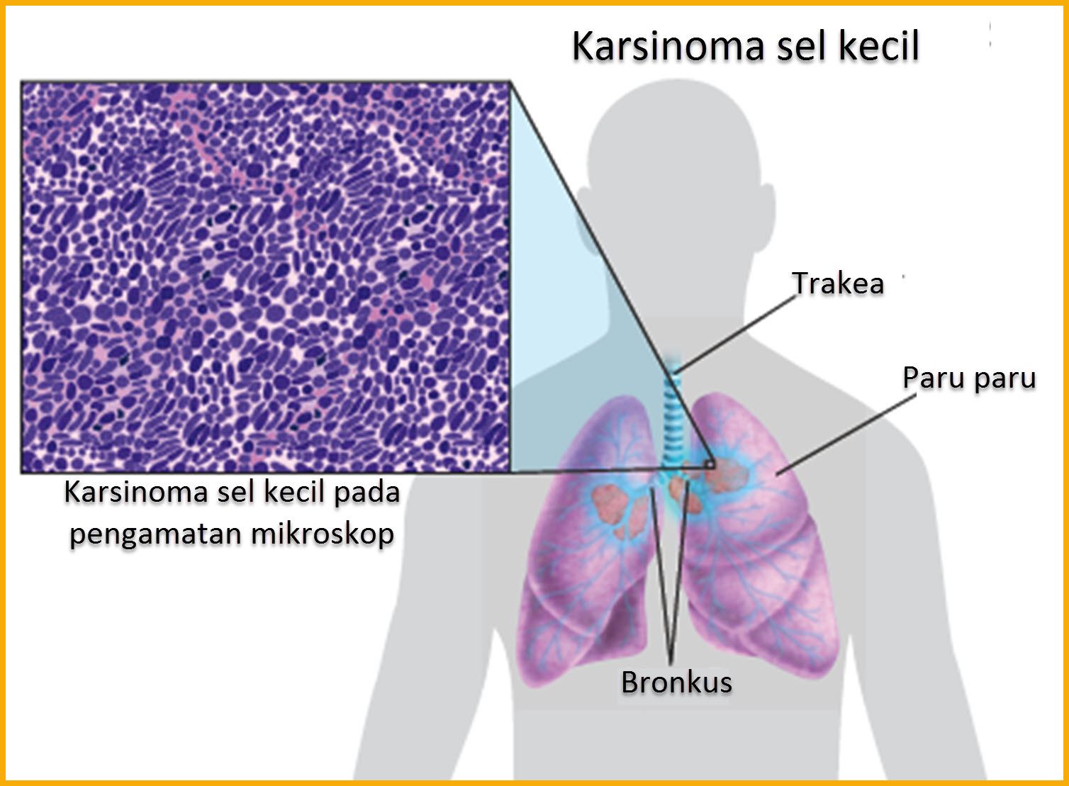 Apa itu karsinoma sel kecil?