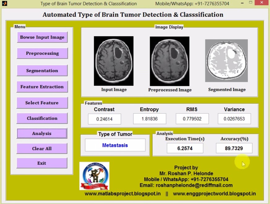 Types Of Brain Tumor Detection Using Matlab Project Source