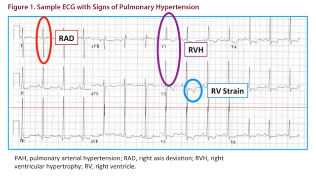EM Didactic: Pulmonary Hypertension