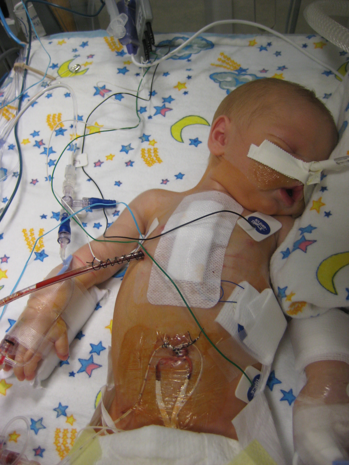 Baby Scarlett's Story: Scarlett post-op