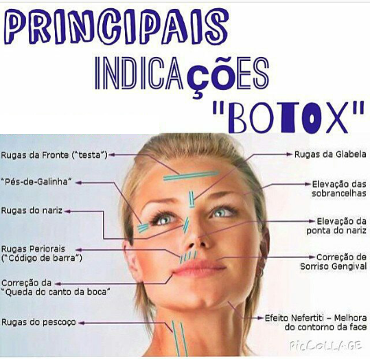 Ortodontia e Estética: Botox na Odontologia