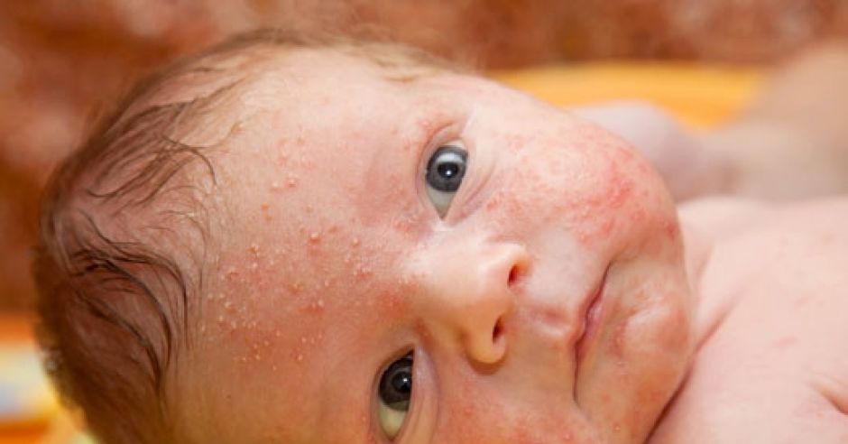 Ajurweda-w-życiu-i-biznesie: Drożdżyca, kandydoza - cz.II