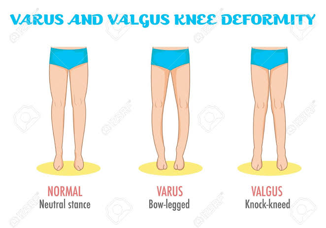 SAMARPAN PHYSIOTHERAPY CLINIC: Knee Valgus Deformity : Overview: