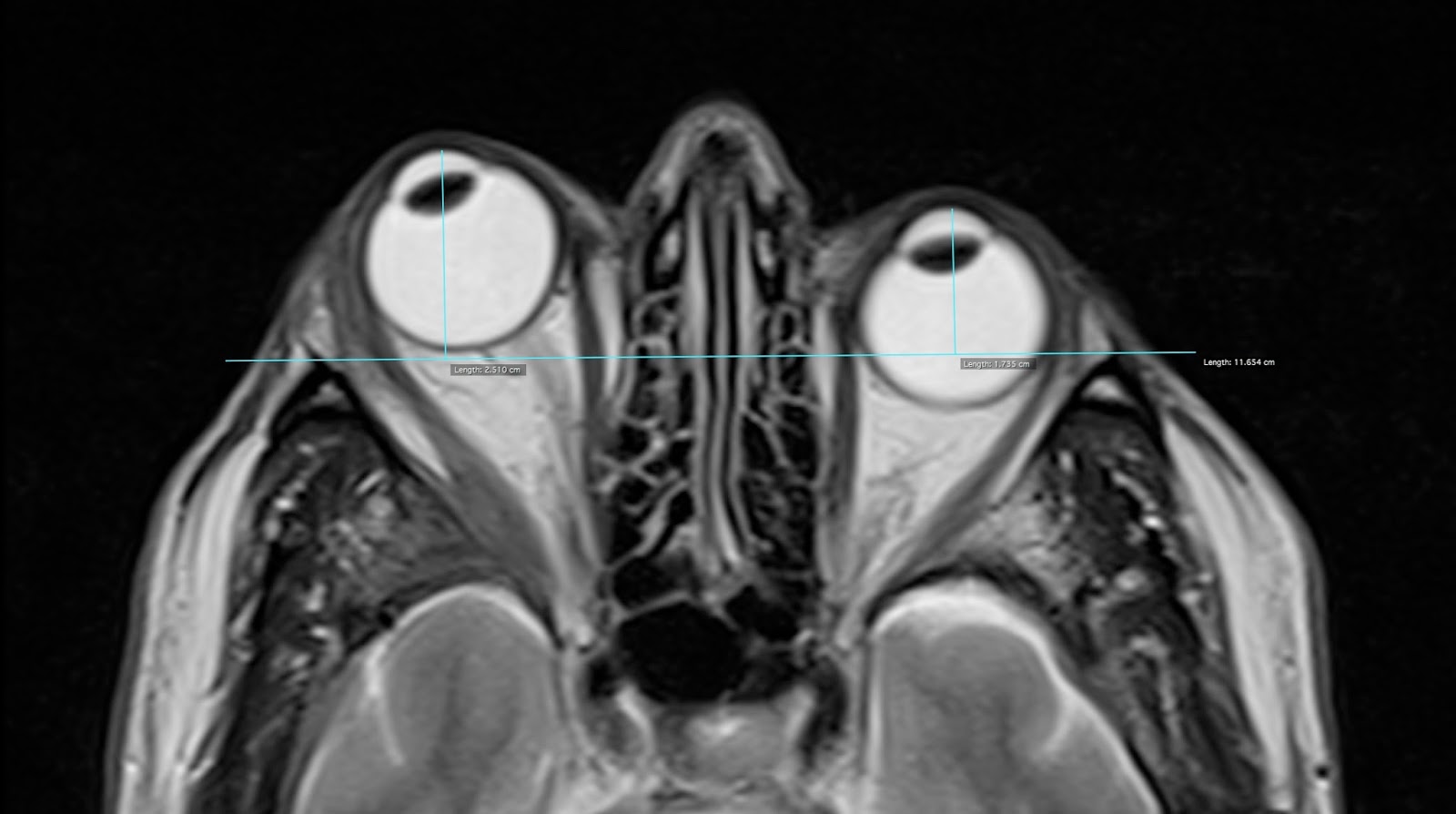 Ultimate Radiology : Meningioma / hemangiopericytoma presenting as ...