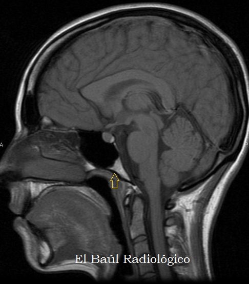 El Baúl Radiológico: SINCONDROSIS ESFENOBASILAR. (Sphenobasilar ...