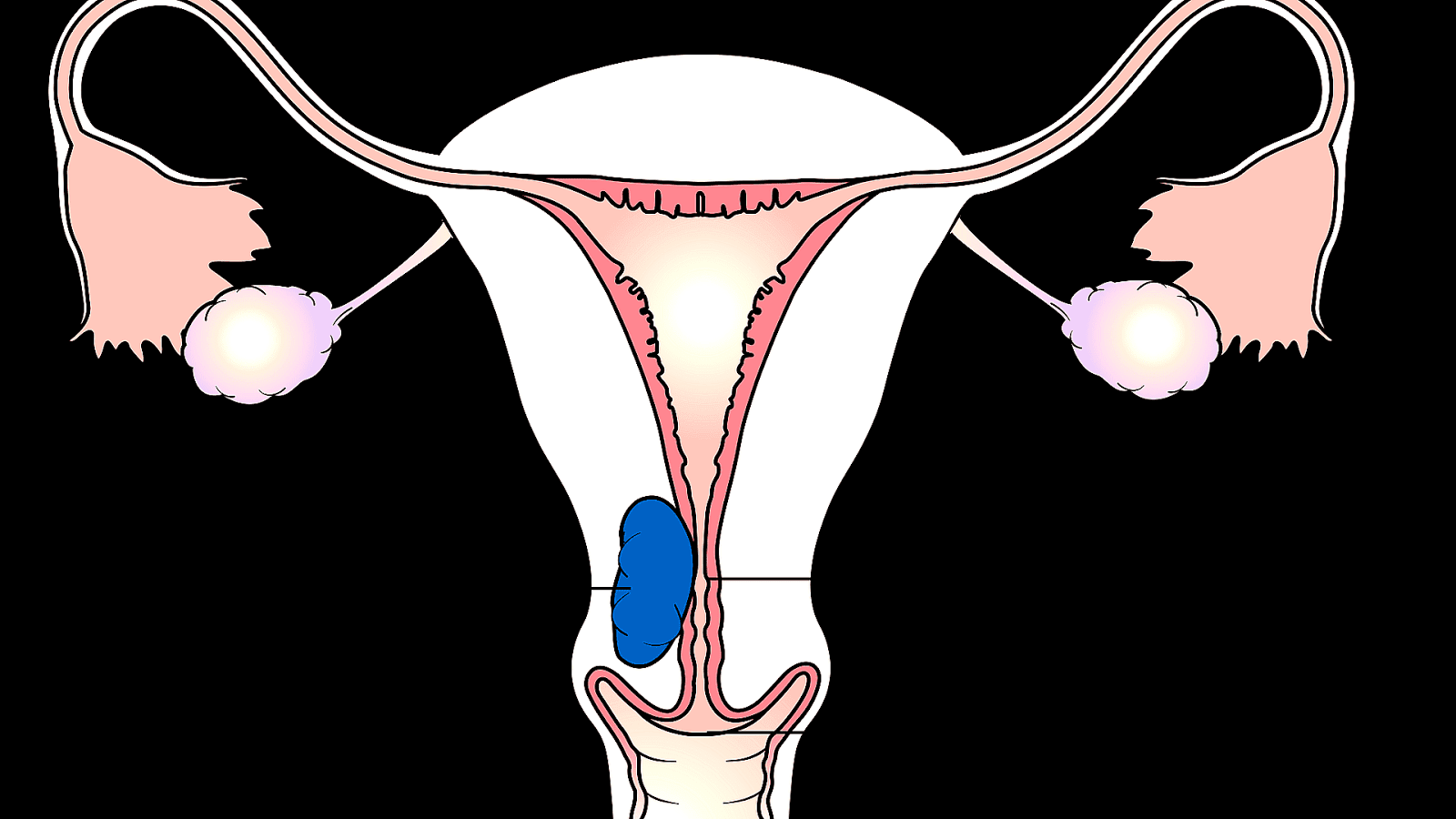 Uterine Cancer Symptoms After Menopause Menopause Choices uterine-cancer-symptoms-after-menopause-menopause-choices